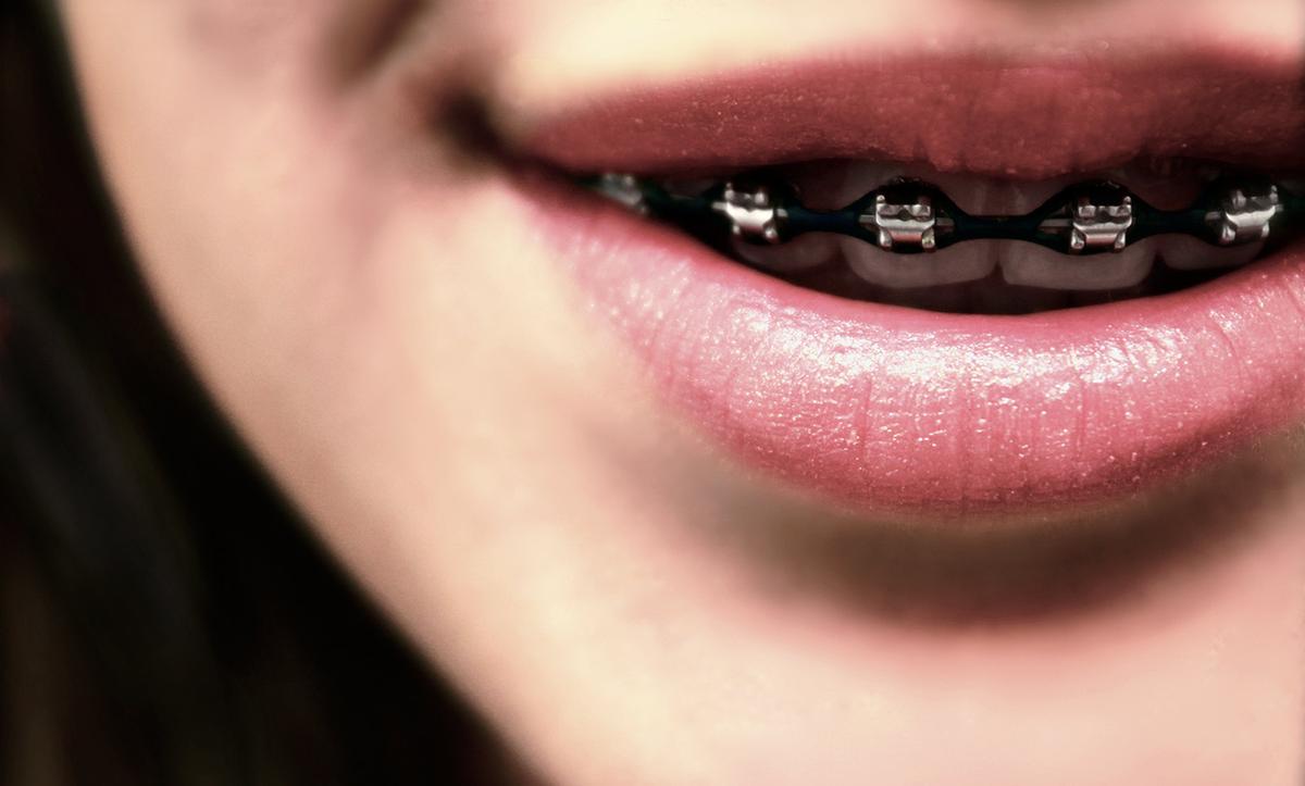 It’s not that your teeth are too big: your jaw is too small | Aeon Ideas