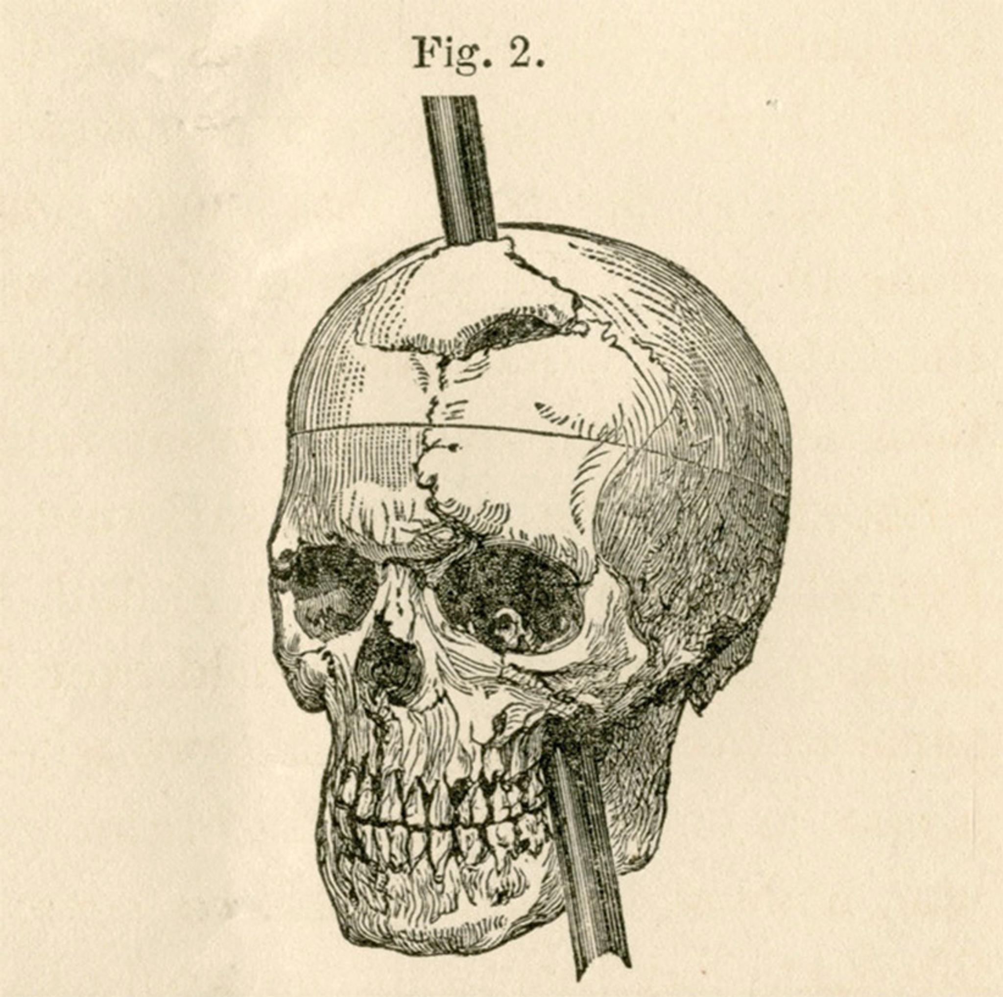 How the ‘myth of Phineas Gage’ affects brain injury survivors | Aeon Essays