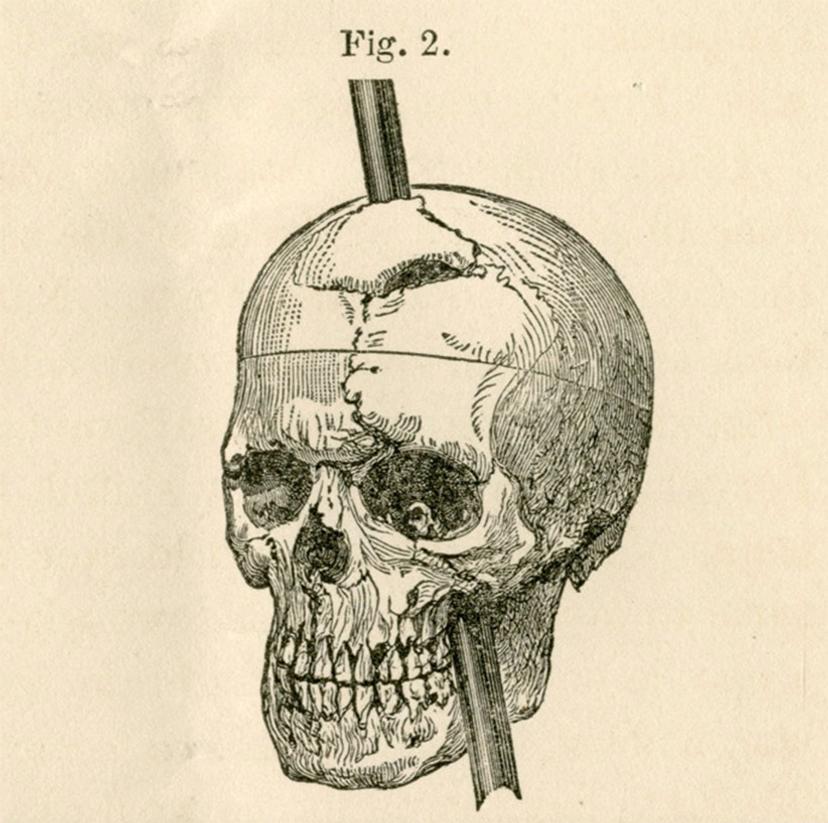 How the ‘myth of Phineas Gage’ affects brain injury survivors | Aeon Essays